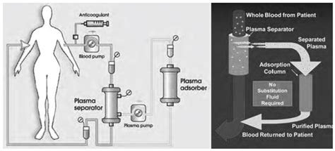 Immuno Adsorption Ia Plasmapheresis Download Scientific Diagram