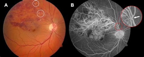Comorbidity In Patients With Branch Retinal Vein Occlusion Case