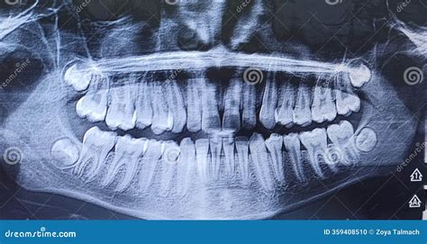 Radiograph Dental X Ray Of A Caucasian Male With Dental Implant