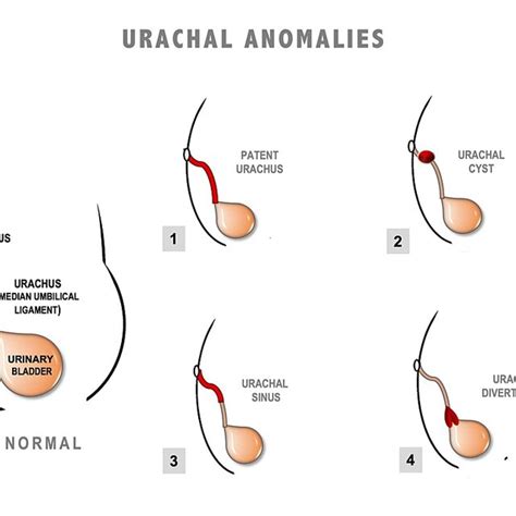 Schematic Representation Of The Four Types Of Urachal Anomalies