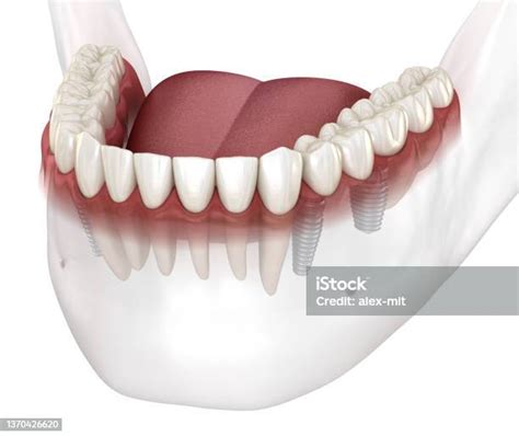 임플란트에 의해 지원되는 치과 다리 인간의 치아와 의치 개념의 의학적으로 정확한 3d 그림 건강관리와 의술에 대한 스톡 사진 및 기타 이미지 Istock