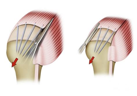 Rotator Cuff Surgery Preparation At Ryan Azure Blog