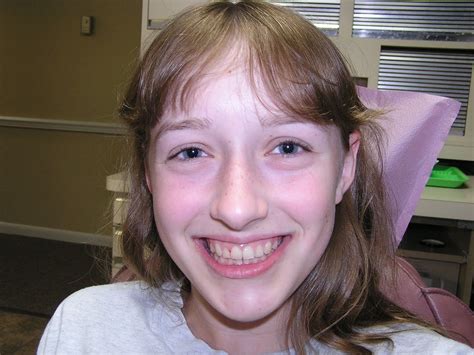 Lizs World Good Bye Braces