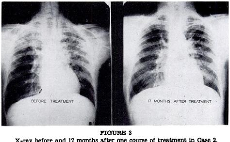 Tuberculosis Patient Before And After