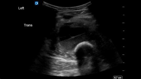 Muscle Normal And Pathology Internet Book Of Msk Ultrasound