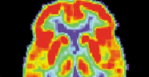 Brain Thermography Brain Thermography