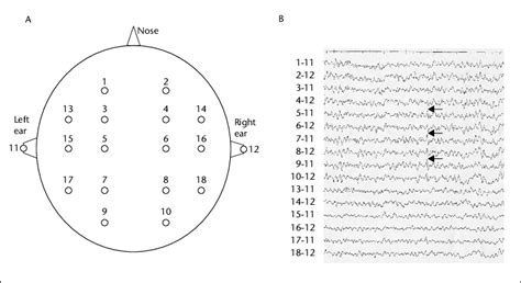A Electroencephalography Mapping Recording The Electrical Activity