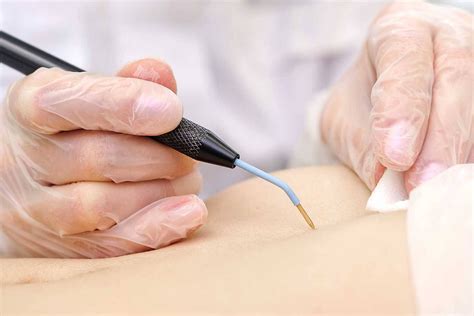 Cauterization Procedures Obstetrician And Gynecologist Cauterization Procedures Obstetrician And Gynecologist