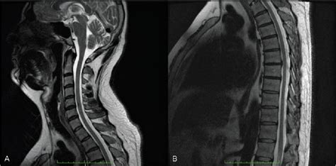 Figure 3 From Medullary Paracoccidioidomycosis Treated Successfully