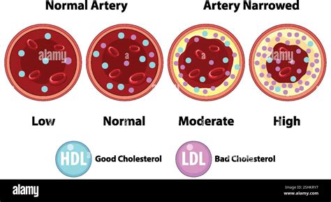 Visual Comparison Of Cholesterol Impact On Arteries Stock Vector Image