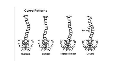 Pre Lenke Scoliosis Classificationpptx