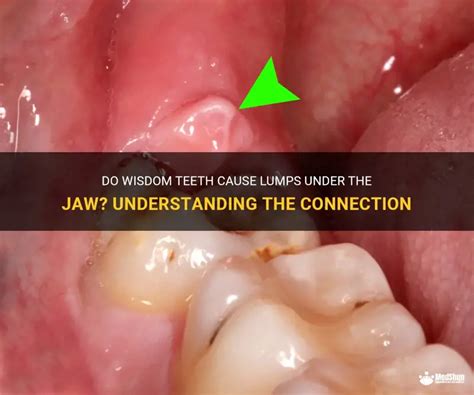 Do Wisdom Teeth Cause Lumps Under The Jaw Understanding The Connection Medshun