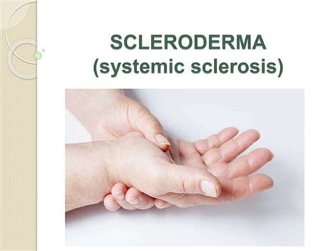 Systemic Lupus Erythematosus Sle Ppt
