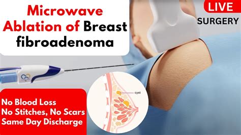 Microwave Ablation Of Breast Fibroadenoma Non Surgical Treatment