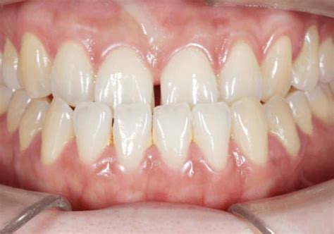 What Is A Crossbite Causes Symptoms And Treatment Caspersmile