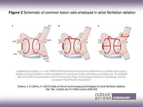 Ppt Figure 2 Schematic Of Common Lesion Sets Employed In Atrial