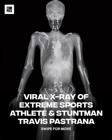 Viral X Ray Of Extreme Sports Athlete Travis Pastrana 😬 This X Ray Of