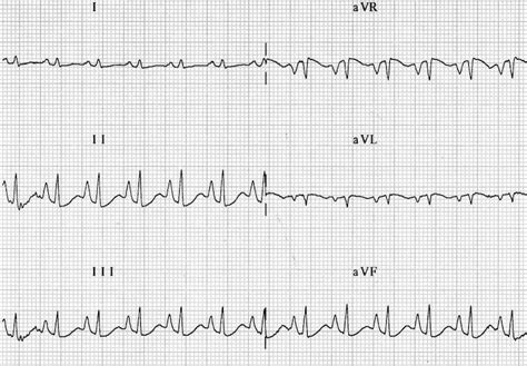 Right Atrial Enlargement • Litfl Medical Blog • Ecg Library Basics
