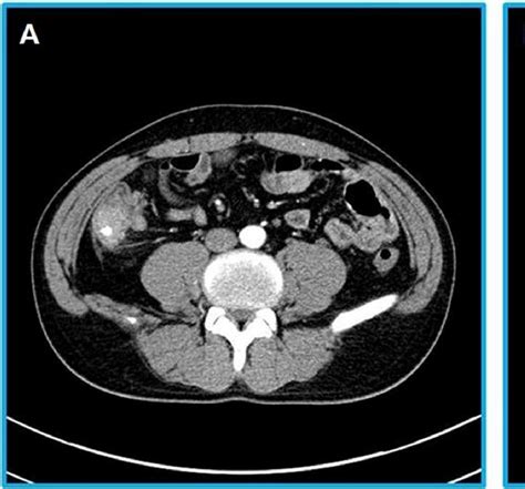 Figure 2 From Actinomycosis Of The Appendix Mimicking Cecal Tumor