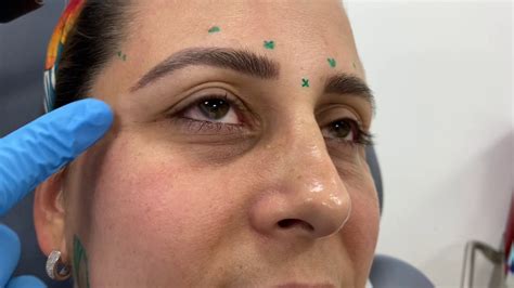 Dysport Treatment For Upper Face Lines And Enlarged Masseter Muscles