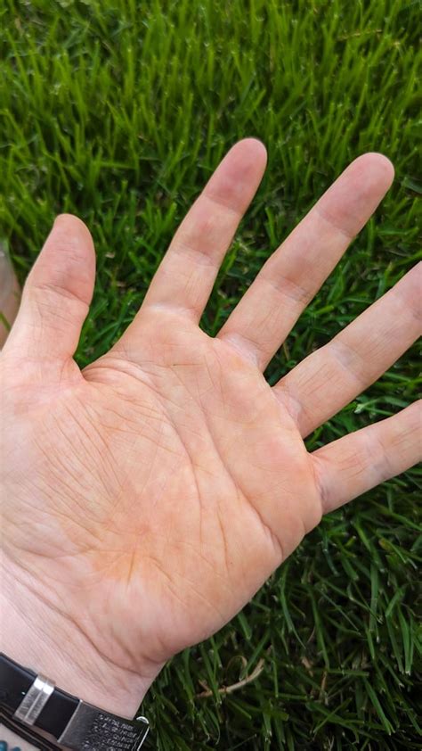 Hands Turning Orange Rmedical