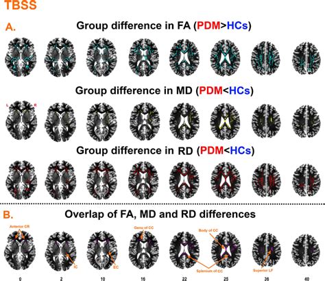 Tbss Findings A Regions Showing Increased Fa Fig 2a First Row Download Scientific