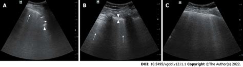 Lung Ultrasound Image A Lung Ultrasound Image Obtained With Convex