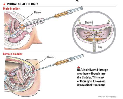 Bcg Instillations Helderberg Urology