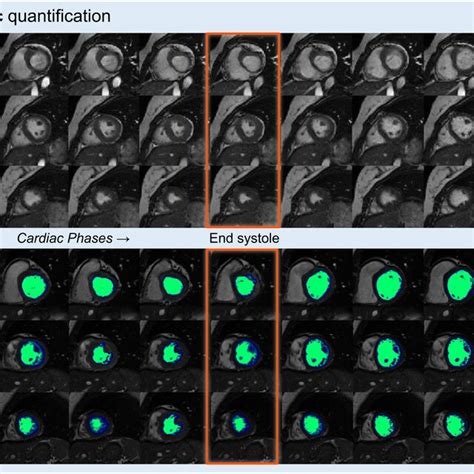 Late Gadolinium Enhancement Lge Cmr For Myocardial Viability Lge‐cmr Download Scientific