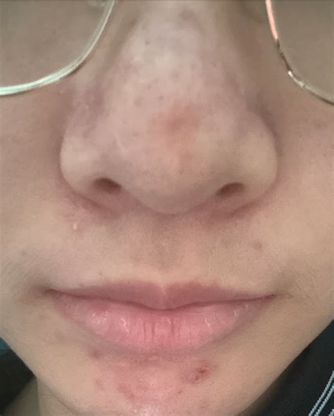 단기간안에 여드름 없애는법 지식in