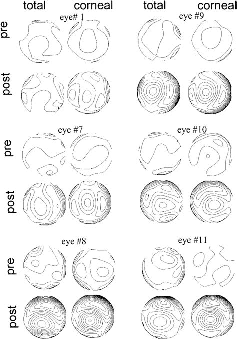 Total And Corneal Wave Aberration Contour Plots Thirdorder And Higher