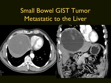 Klatskin Tumor Metastasis