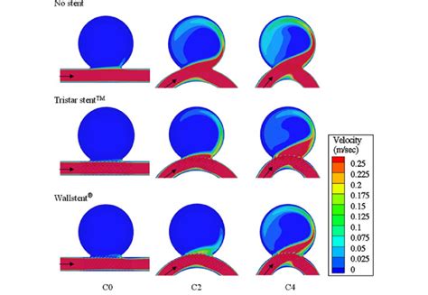 Velocity Contours On The Center Plane Idealized Aneurysm Model