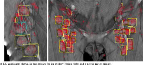 figure 2 from automatic detection and segmentation of lymph nodes from