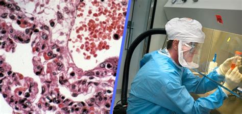 Need To Know About Nipah Virus And How To Prevent It