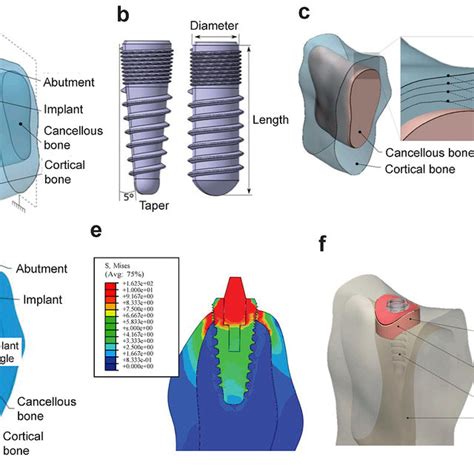 A Finite Element Models Boundary Conditions And Loading B Implant