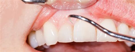 White Gums Causes And Treatment
