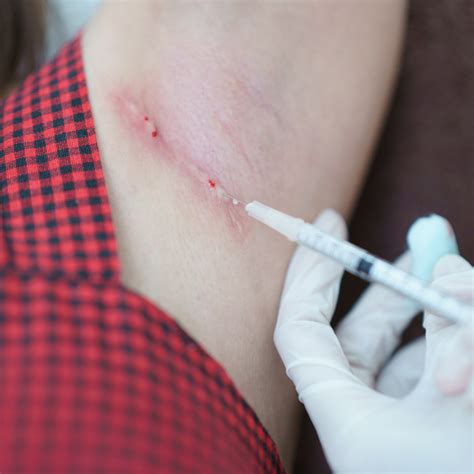Cystic Acne Scar Injections — Willow Medspa And Skincare Center