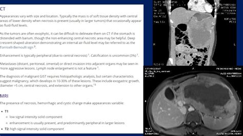MEDIC Gastrointestinal Stromal Tumor GIST A Case Report