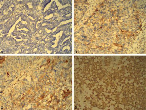 Figure 1 From Htra 2 Omi Protease In Epithelial Ovarian Carcinoma Clinical Significance And