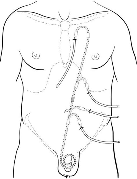 Selected Best Demonstrated Practices In Peritoneal Dialysis Access