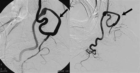 Postoperative Left Vertebral Angiograms Confirming Patency Of The