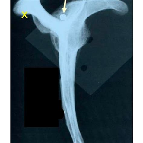 The Different Acromial Shapes Flat Curved Hooked And Reversed Download Scientific Diagram