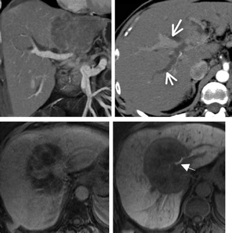 Assessment Of Treatment Outcomes In Patients With Advanced Hilar Cholangiocarcinoma Stages Iii