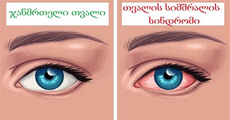 თვალის მუდმივი სიმშრალე გავრცელებული სინდრომია როგორ მოვიქცეთ რჩევები ვივიენისგან