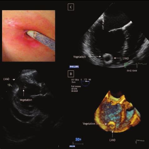 A Left Ventricular Assist Device Lvad Exit Site Infection B