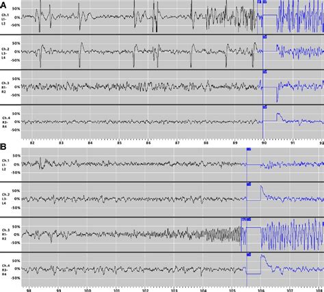 Lateralization Of Mesial Temporal Lobe Epilepsy With Chronic Ambulatory Electrocorticography