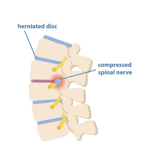 Premium Vector Sciatic Nerve Pinching Concept