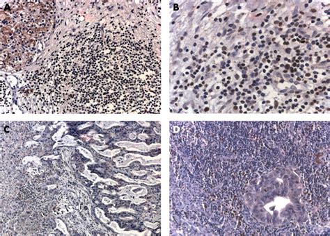 RUNX Expression In Primary And Metastatic Pancreatic Cancer Journal Of Clinical Pathology