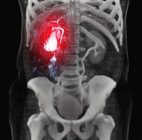 Resonance Cholangiopamagnetic Cholangiopancreatography Stock Illustrations 1 Resonance